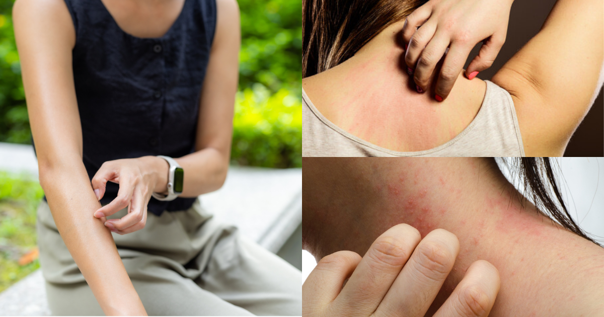 Itchy Bumps on Skin Like Mosquito Bites But Aren’t? Here’s What They C ...